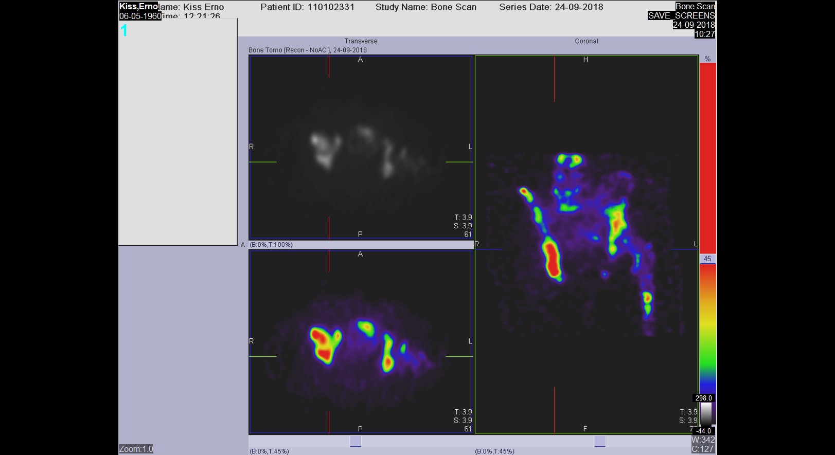 Csontscintigráfia, SPECT - Urodoki